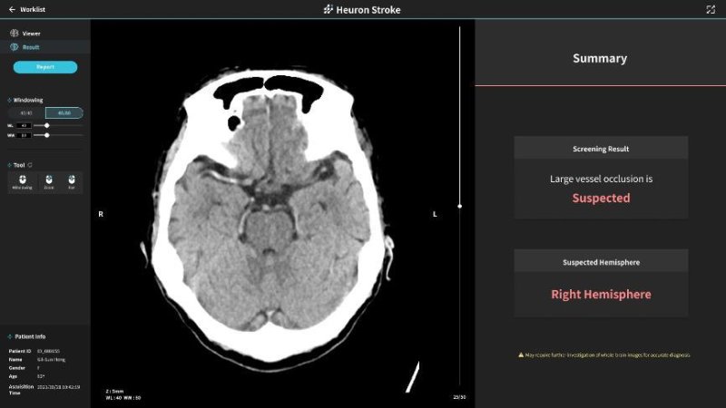 휴런, 뇌졸중 진단보조 AI '휴런엘보' 3등급 의료기 허가 - 파이낸셜뉴스